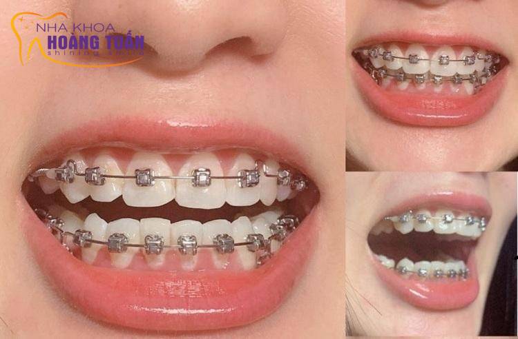 Nắn chỉnh răng khi nào?Độ tuổi niềng răng thích hợp nhất là khi nào?