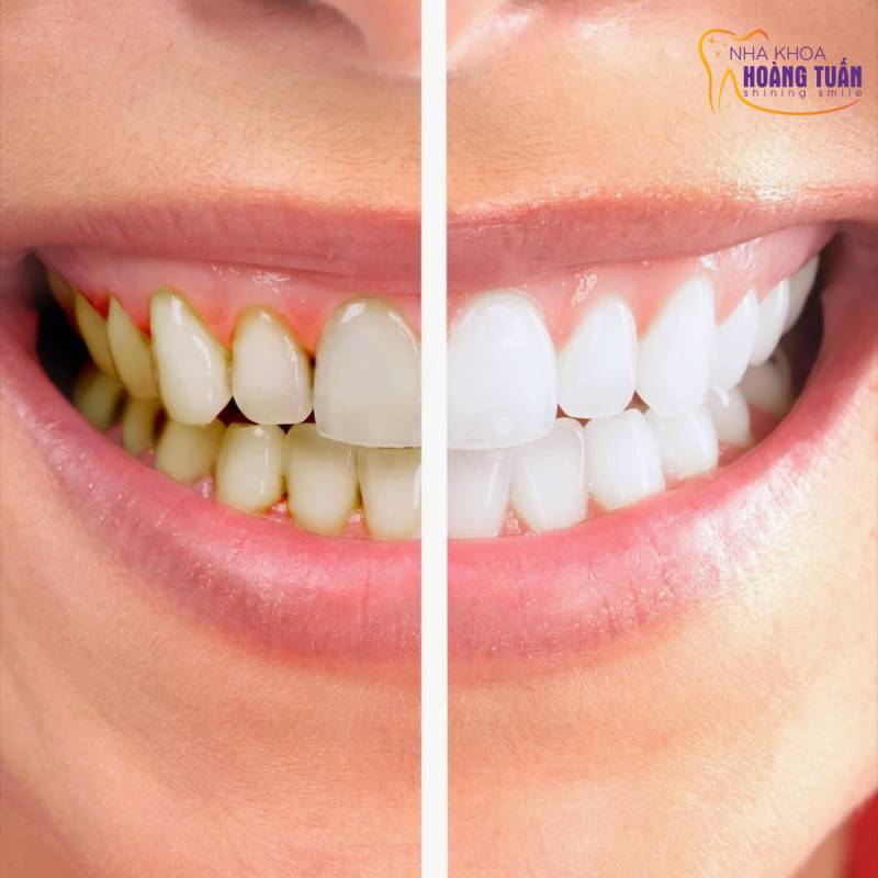 Tẩy trắng răng không đều màu - giải pháp cho hàm răng trắng sáng và đều màu